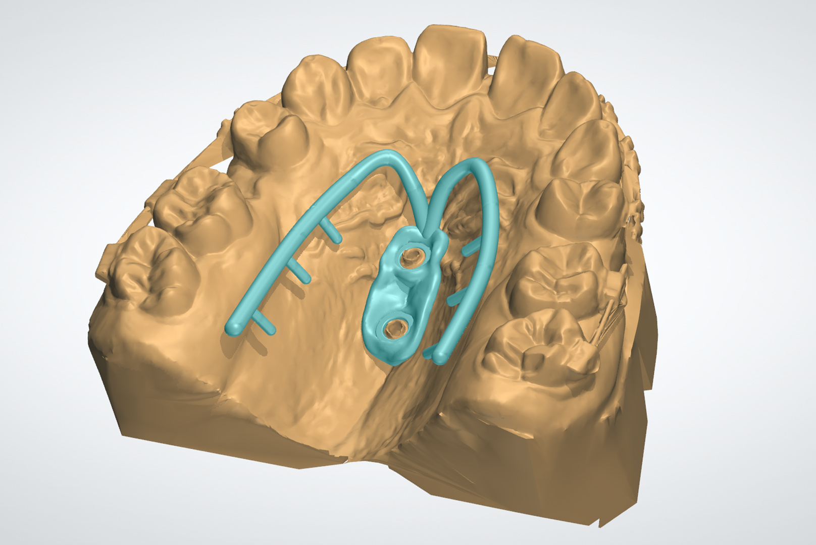 Método directo de aparatología con microtornillos | Ortoplus
